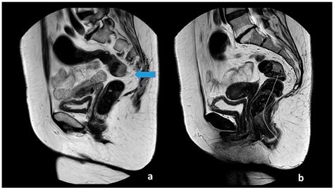 Interobserver Reliability And The Sigmoid Takeoff—an Interobserver Study