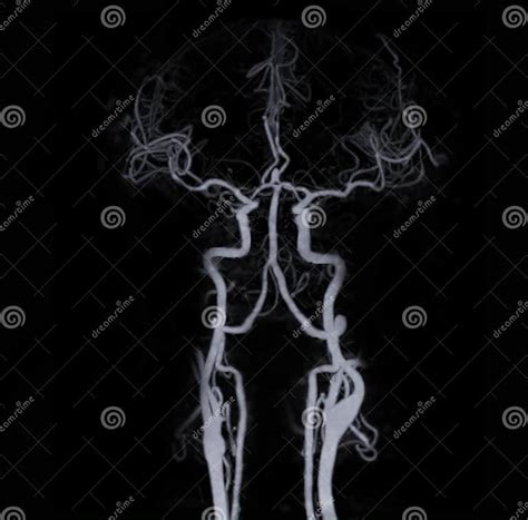 Ct Angiography Of The Brain Or Cta Brain Showing Cerebral Aryery Stock Image Image Of Human