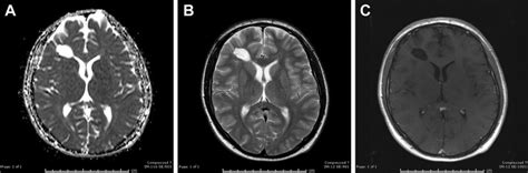 Follow Up Mri At 27 Months Post Ablation The Ablation Site Has Evolved