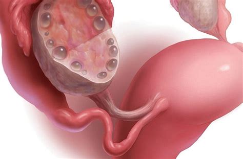 سندروم تخمدان پلی کیستیک علائم، تشخیص و درمان
