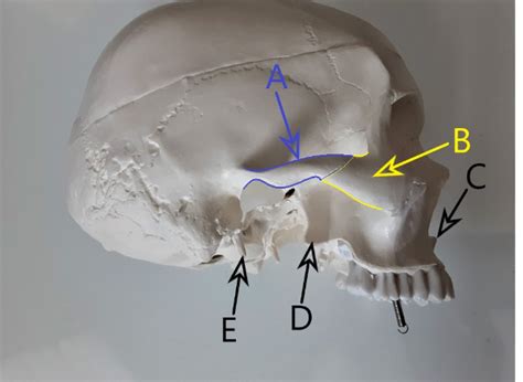 Zygomatic Bone Temporal Process
