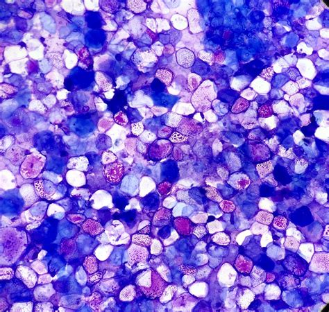 Epidermal Inclusion Cyst Cytology