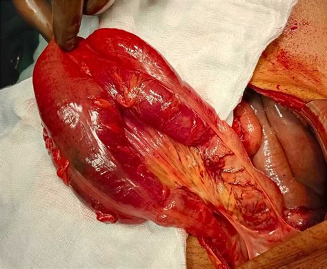 Ileosigmoid Knotting An Unusual Case Of Small Bowel Strangulation Journal Of Gastrointestinal