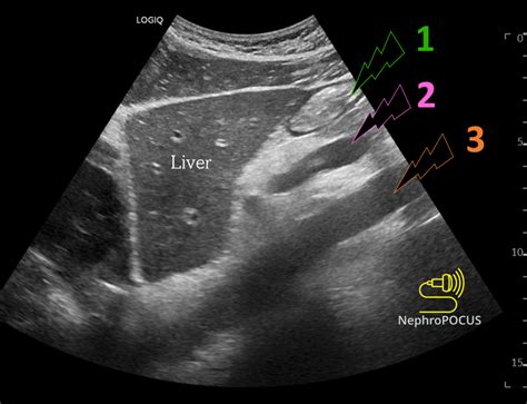 Left Gastric Artery Ultrasound