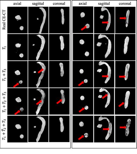 Figure 9 From A Cascaded Multi Task Generative Framework For Detecting Aortic Dissection On 3 D