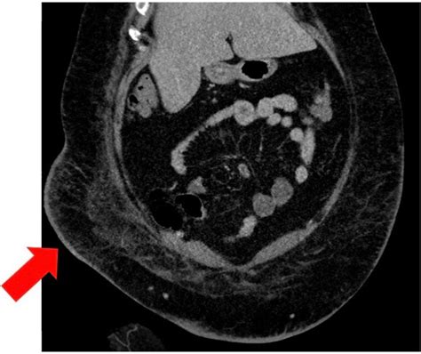 Pyoderma Gangrenosum Following Gynaecological Surgery Bmj Case Reports