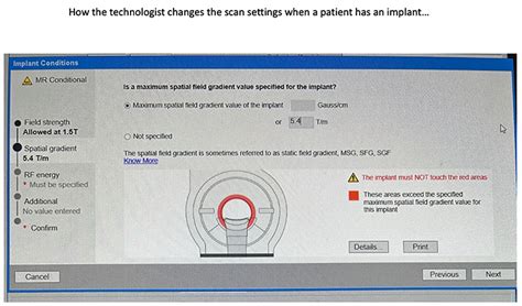 Mri Safety Implants Image Effects And More Radiating Hope