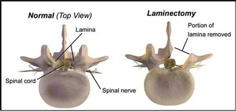 Laminectomy Vs Non Surgical Spinal Decompression What You Need To Know