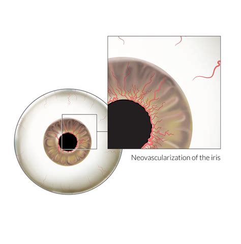 Neovascularization Of The Iris