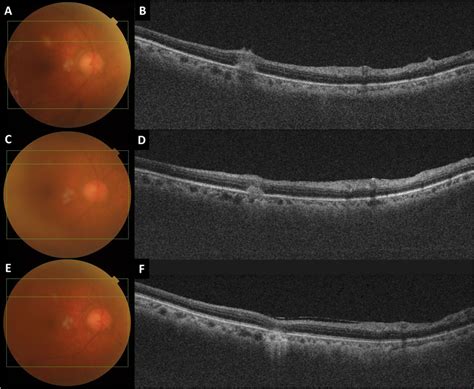 Serial Fundus Photographs And Ss Oct Scans Passing Through A Download Scientific Diagram