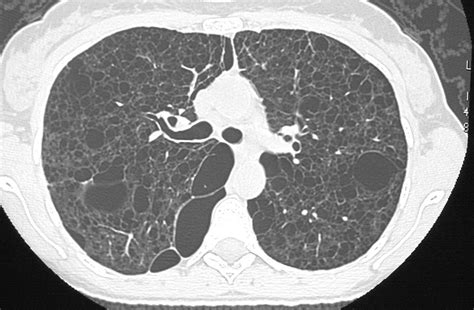 000 Cysts In The Lung The Common Vein