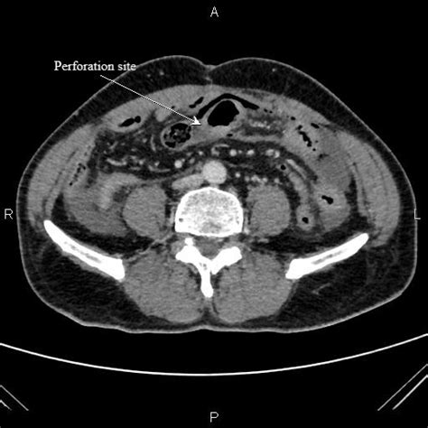응급의학과 Small Bowel Perforation 소장천공 네이버 블로그