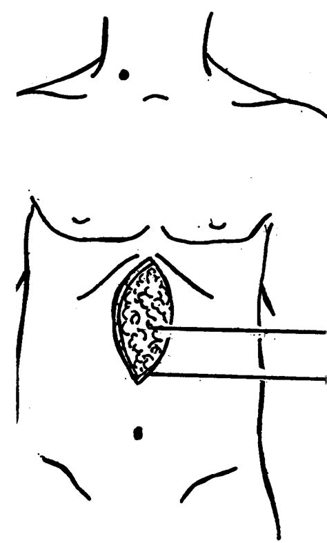 An Over View Of The Incisional Hernia Download Scientific Diagram