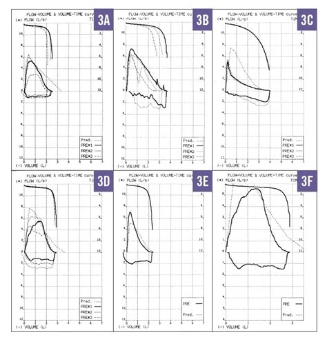 Vocal Cord Dysfunction How To Treat Medical Monday
