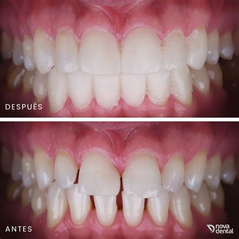 Tratamientos Dentales Estéticos Nova Dental