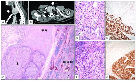 Clear Cell Renal Cell Carcinoma Metastasizing In Papillary Carcinoma Of Download Scientific