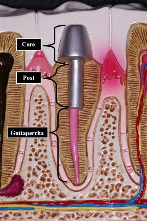 Post And Core Ask A Dentist