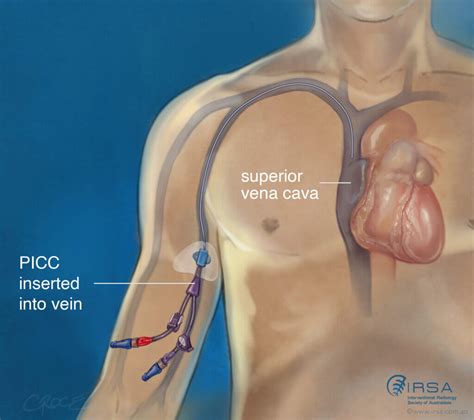Picc Peripherally Inserted Central Catheter Picc Line Interventional Radiology