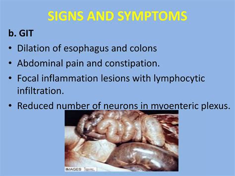 Reduviid Bug T Cruzi And Chagas Disease Pptx