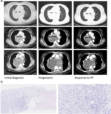 Figure 1 From Successful Treatment Of Pulmonary Inflammatory Myofibroblastic Tumor With Platinum
