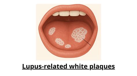 How Do Lupus Mouth Sores Look A Complete Visual Guide