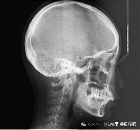 Cl Detection2024——x线图像中头颅侧位关键点检测 知乎