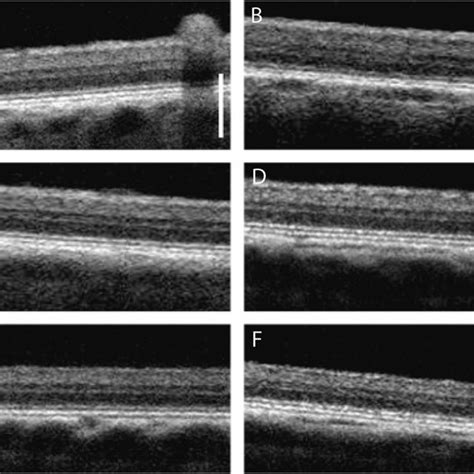 Representative Optical Coherence Tomography Oct Scans Of The Right