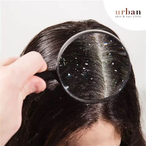 Dandruff Types Causes Symptoms And Treatment Ushc