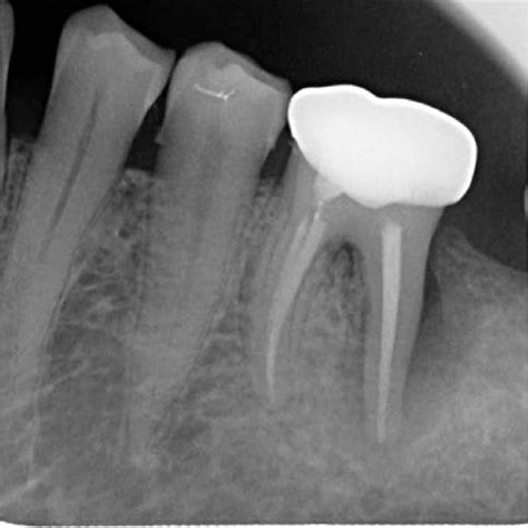 Pdf Diagnosis Of Vertical Root Fractures In Restored Endodontically