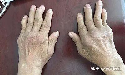 类风湿的五个临床分期，看看你到哪一期了 知乎