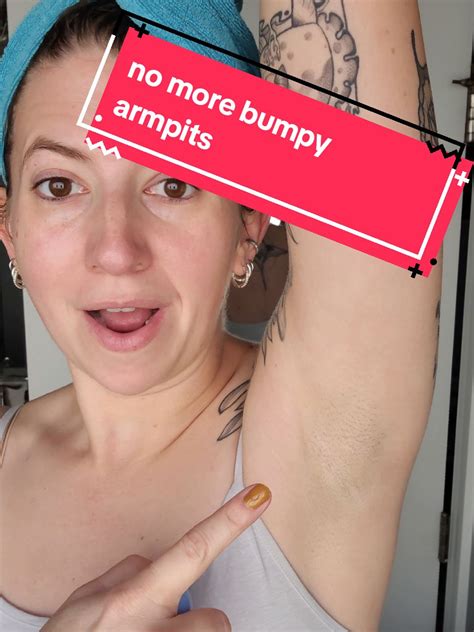 Ingrown Hair Lump Cyst Bump Under Skin On Neck Armpit Ingrown Hair