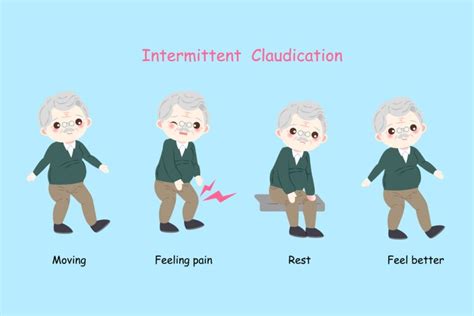 What Are The Signs Of Intermittent Claudication Phlebotomy Trainingphlebotomy Training