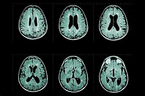 Ms Brain Mri With Contrast