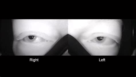 So What Does Bppv Look Like Using Our Infrared Video Goggles 🥽👩‍🔬 Why Do Our Specialists Use
