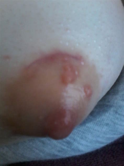 Chirurgy Cyst Porn Pictures Xxx Photos Sex Images 4005100 Pictoa