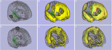 Frontiers Stereoscopic Three Dimensional Visualization Applied To Multimodal Brain Images