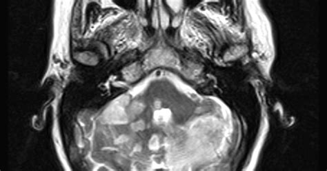 A Mini Stroke Is Not Just A Funny Turn Huffpost Uk Life