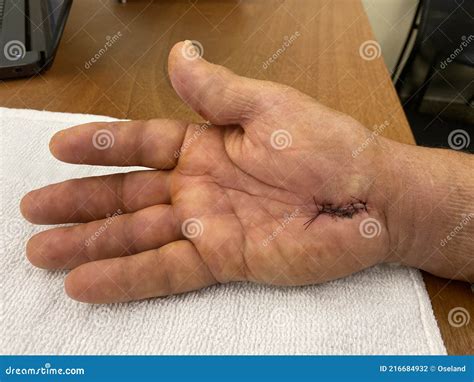 Man S Swollen Hand Carpal Tunnel Syndrome Sutures After Surgery