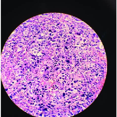 Colonoscopy Report Irregular Lumps Can Be Seen The Surface Is Uneven