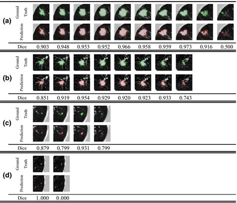 Segmentation Results Of Lung Nodules With Different Sizes By 3d Res
