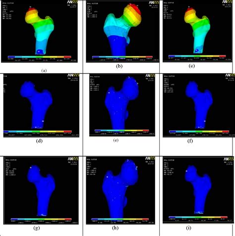 Figure 1 From Finite Element Analysis Of Femur In The Evaluation Of Osteoporosis Semantic Scholar