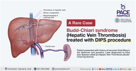 Transjugular Intrahepatic Portosystemic Shunt Diagram