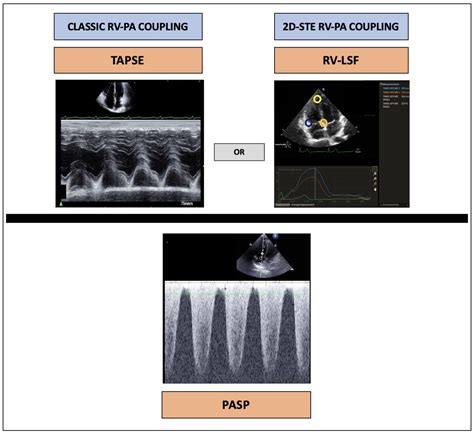 Parameter Z Score Pulmonary Artery At David Dicken Blog