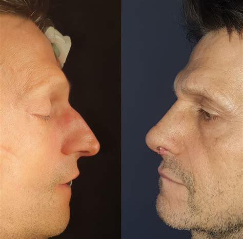 Rinoplastia Antes Y Después Descubre Los Resultados Reales