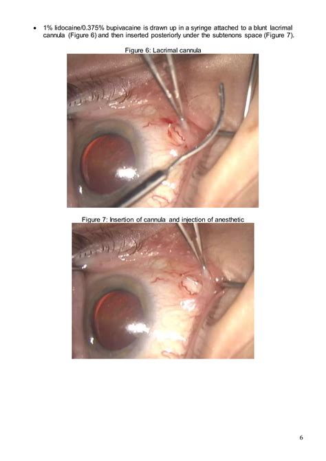Retrobulbar Block Doc