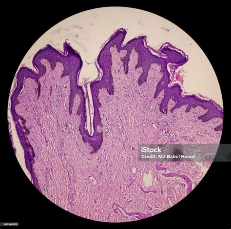 Scrotal Wall Calcinosis Cutis Show Skin Subepithelial Tissue Of Extensive Calcification Stock