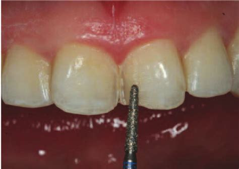 Interproximal Surface Of The Tooth Definition At Bennie Keim Blog