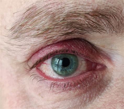 What Causes Blepharitis And How Do You Treat It