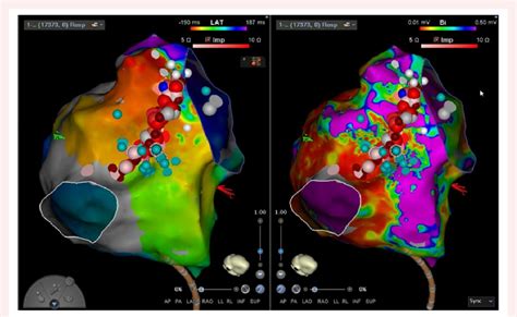 Istmo Dependent Atrial Flutter Ablation With Electroanatomic System Download Scientific Diagram
