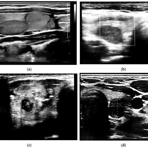 Benign Thyroid Nodules A Halo Isoechoic Solid Nodules Without Download Scientific Diagram